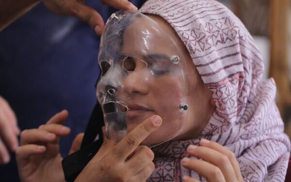 3D Printed Compression Masks Treating Burns in Gaza - 3D Printing