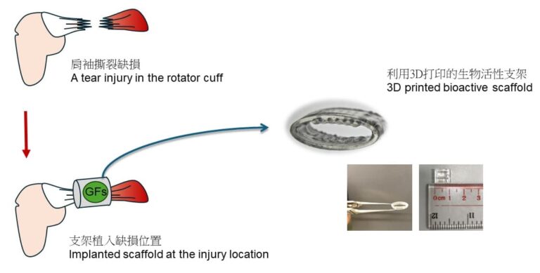 3D Printed Elastomer Aids Rotator Cuff Recovery - 3D Printing