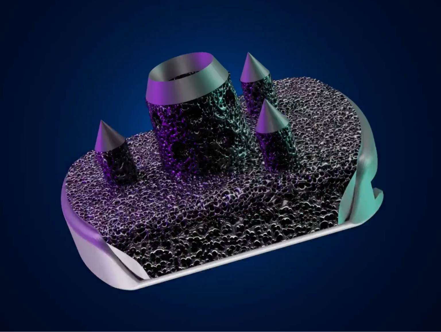 Exactech Highlights First Ankle Replacements with 3D-Printed Tibial ...