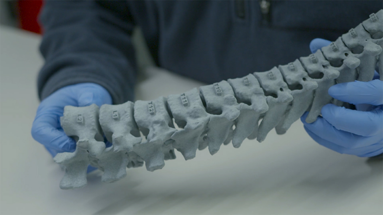 Mighty Oak Medical Forms Partnership for Printing Spinal Models - 3D ...