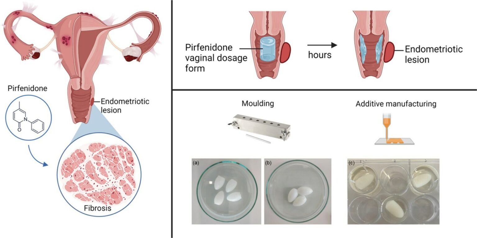 3D Printed Vaginial Ovules Show Promise as Endometriosis and Leiomyoma ...