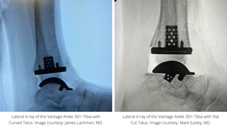 Exactech Highlights First Ankle Replacements with 3D-Printed Tibial ...